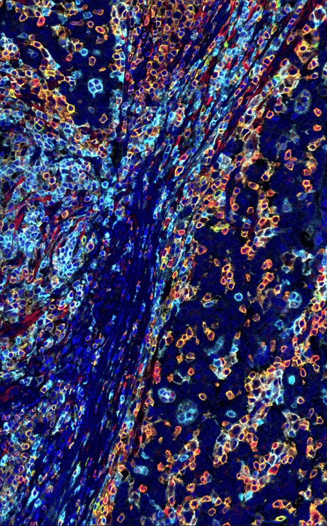 Spatial Insights for CAR-Engineered Cells in Solid Tumors | CST Blog